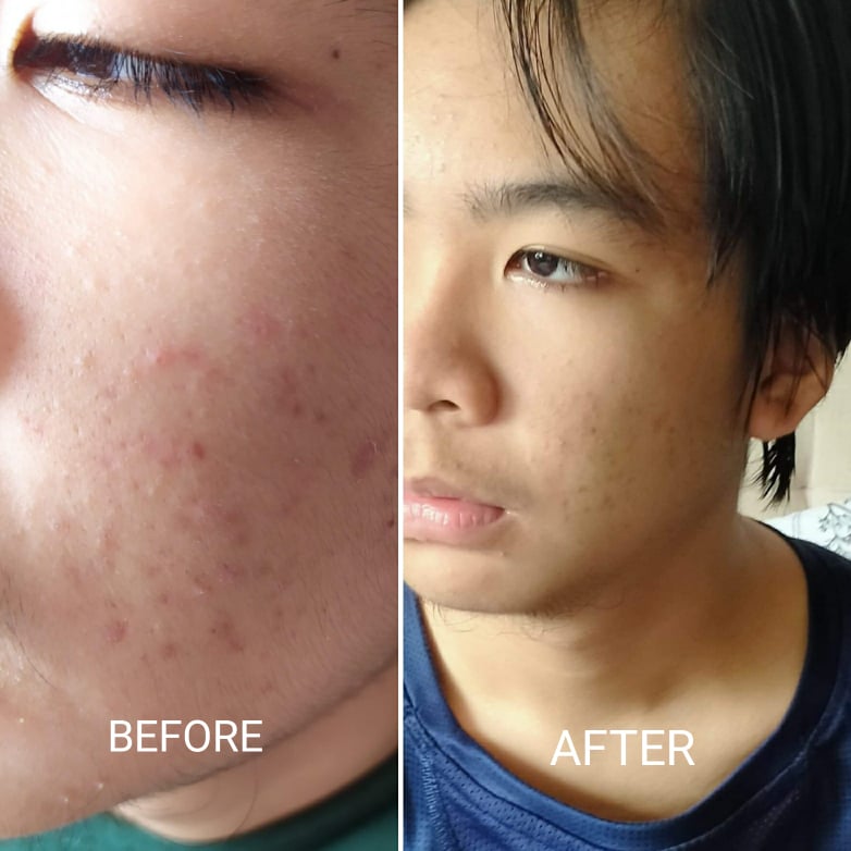 Affordable and Quick Way to Control Acne Breakout - Mommy Levy